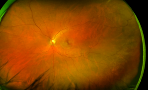 Optomap | The Eyecare Studio