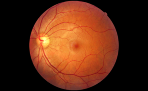Optomap | The Eyecare Studio